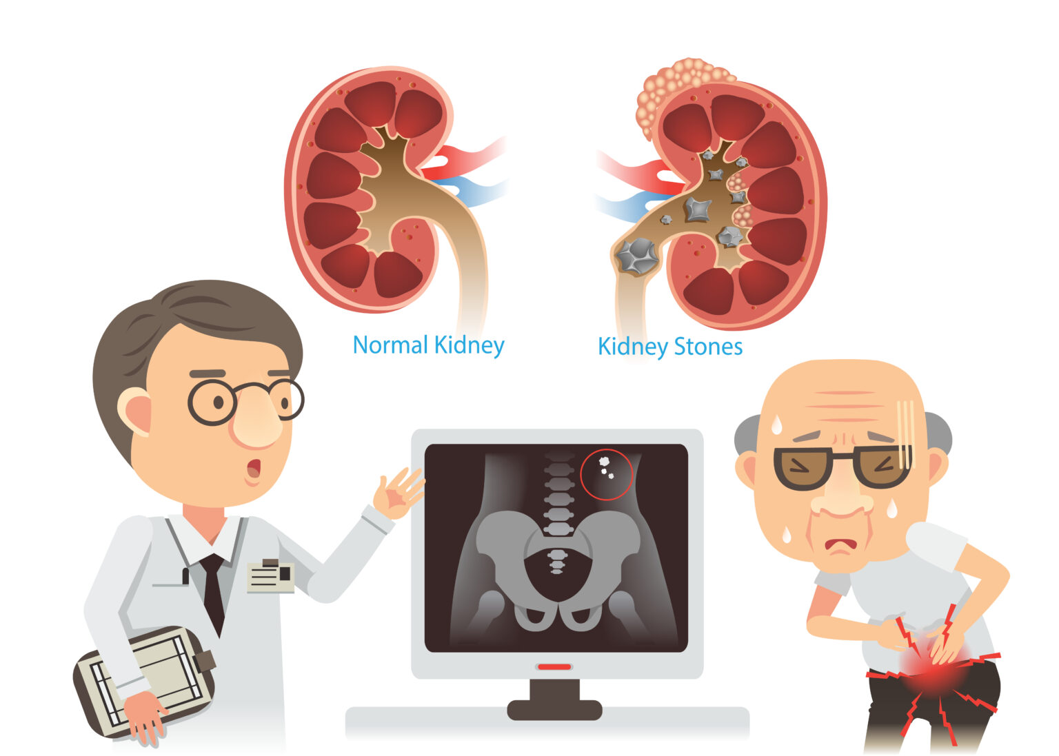 What Size of Kidney Stone Requires Surgery? - Dr Muthana Alrawi